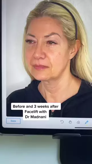 viagra before and after photos
